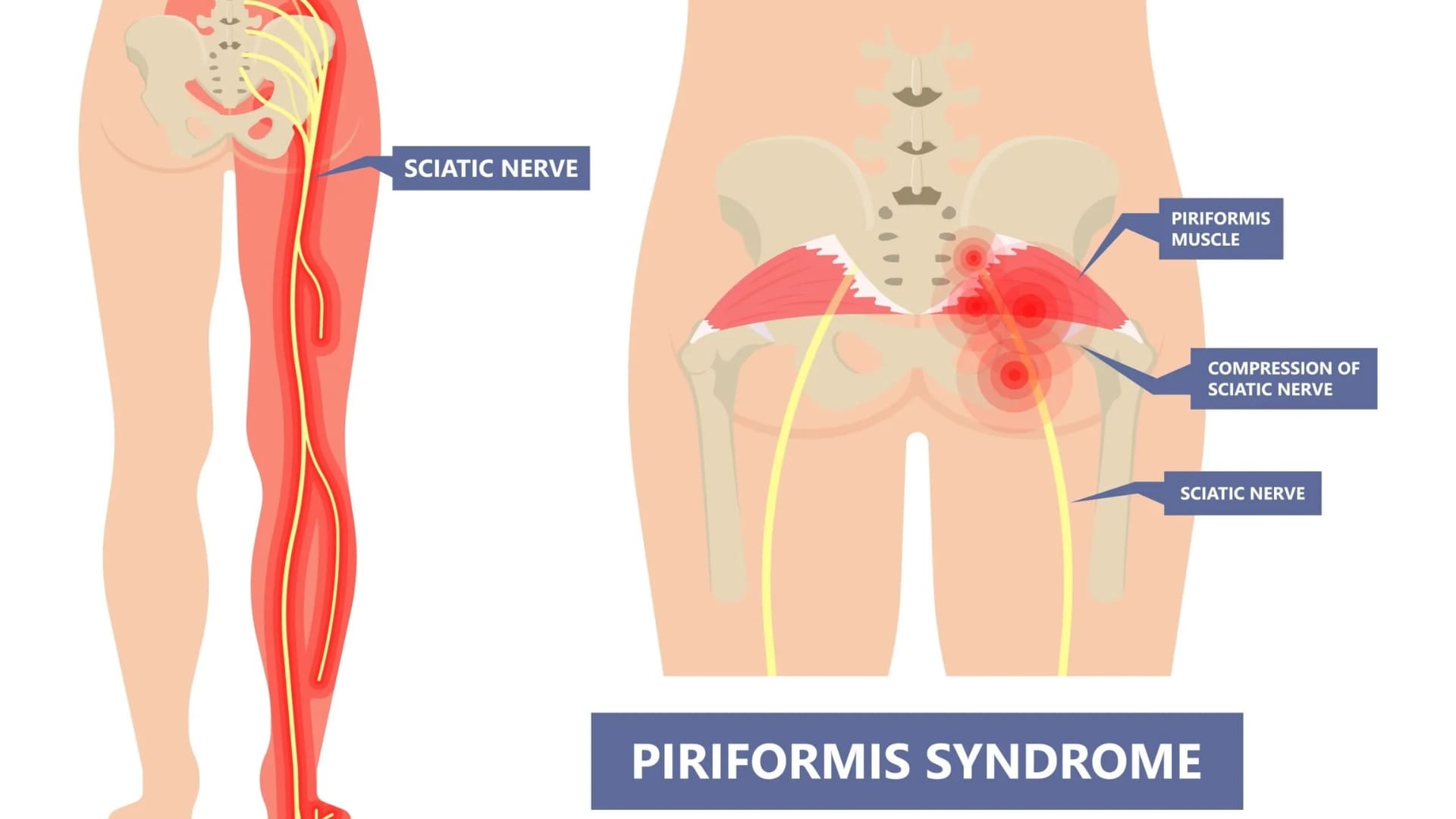 Piriformis Syndrome vs Sciatica: Key Differences | Global Clinic